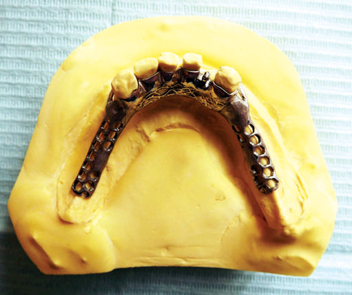Post Op Instructions For Amalgam Restorations keyletabba